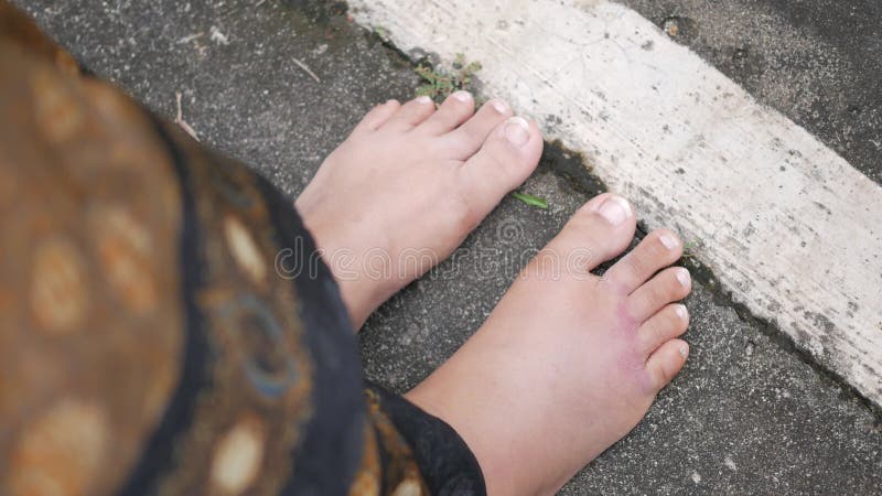 Close-up Swelling of the Tongue. Allergic Reactions, Infections ...