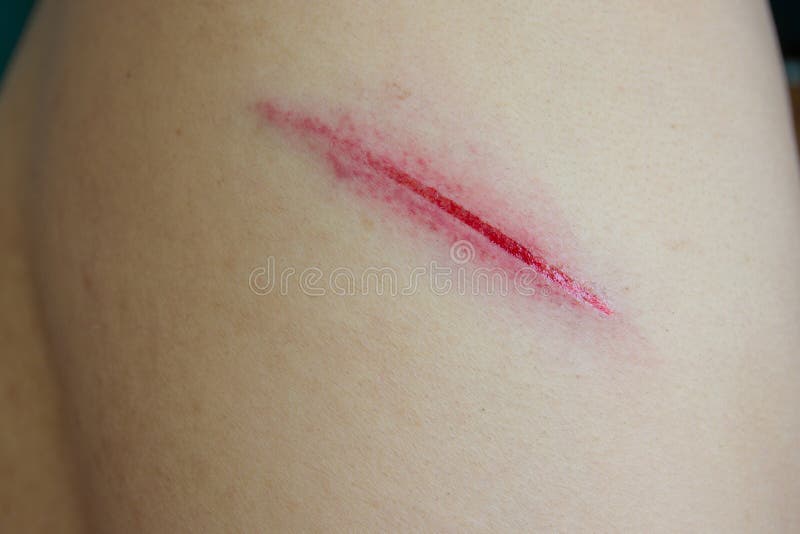 Wound on Back, Fresh Wounds Stock Photo - Image of scratch, human ...