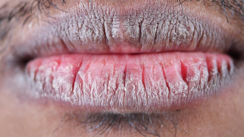 Close Up of a Young Dry Lips Stock Footage - Video of hand, face: 267185484