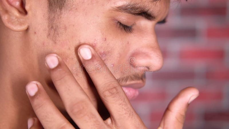 Close Up of Young Man Face with Skin Problem . Stock Footage - Video of ...