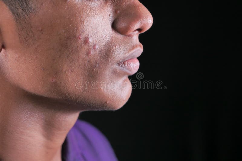 Close Up of Young Man Face with Skin Problem . Stock Photo - Image of ...