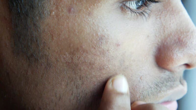 Close Up of Young Man Face with Skin Problem . Stock Footage - Video of ...