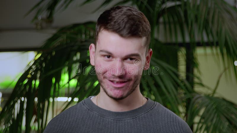 Close-up of a Young Man with Pimples on His Face. the Guy Makes a Face ...