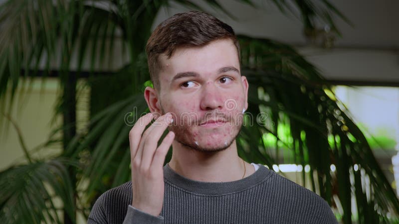 Close-up of a Young Man with Pimples on His Face. the Guy Puts Cream on ...