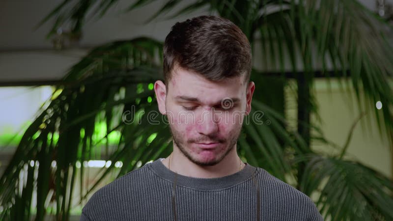 Close-up of a Sad Young Man with Glasses and Pimples on His Face ...