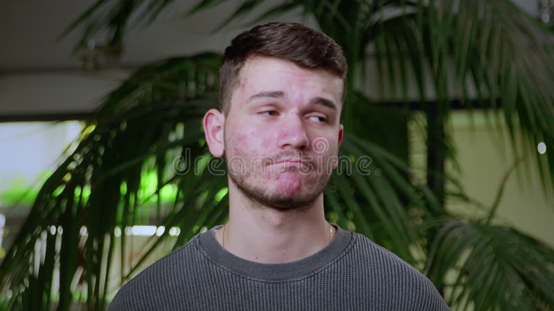 Close-up of a Young Man with Pimples on His Face. the Guy is Sad and ...