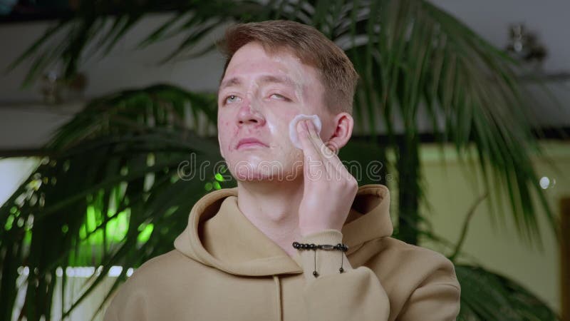 Close-up of a Young Man with Pimples on His Face. the Guy is Joyful and ...