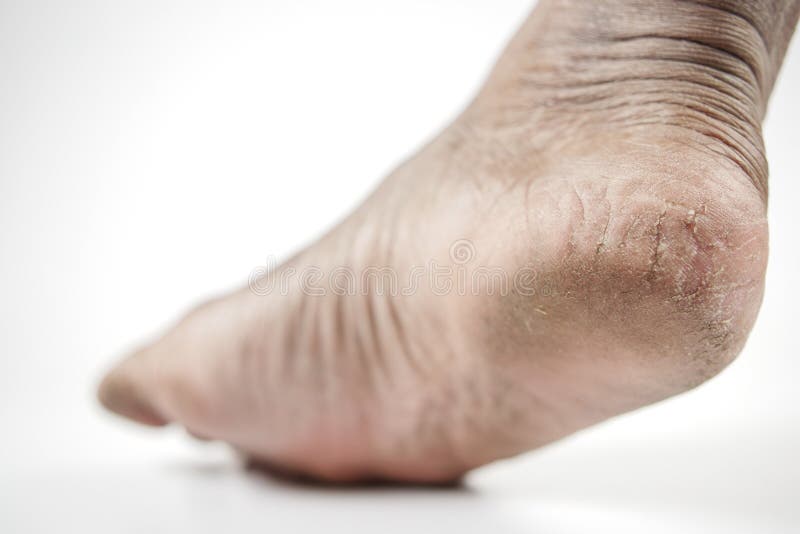 Close Up of Young Men Dry Feet on White Stock Image - Image of human ...