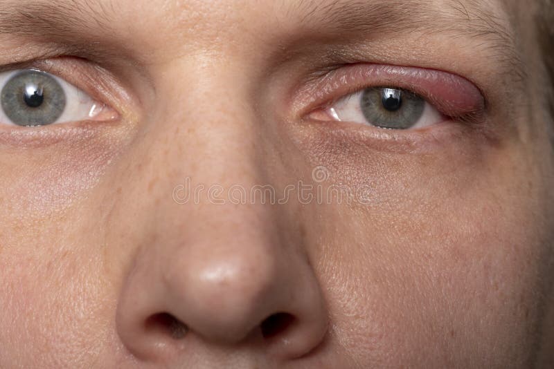 110 Streptococcus Eye Stock Photos - Free & Royalty-Free Stock Photos ...