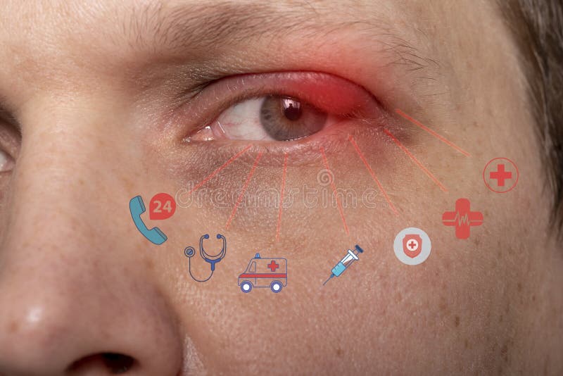 Close the Upper Left Eyelid Abscess. Eye with Barley Stock Photo ...