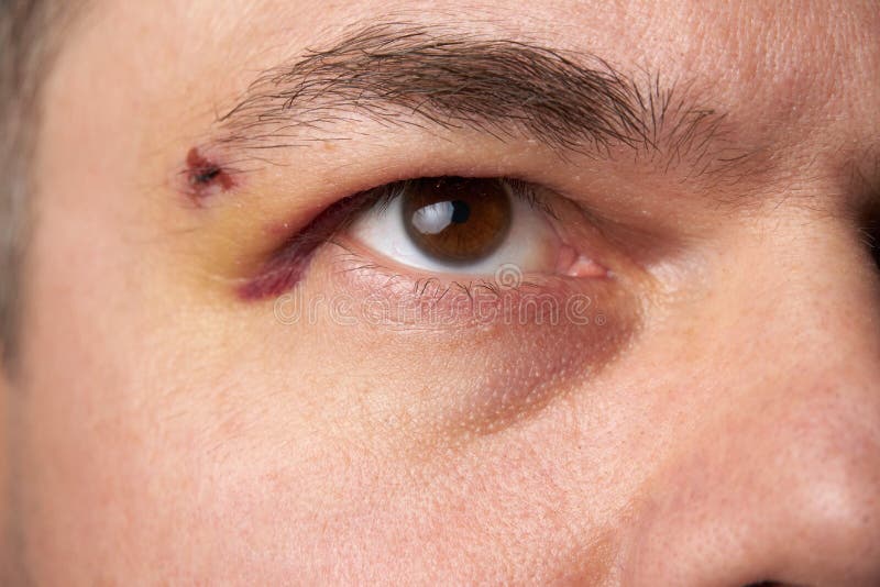 Close View of a Bruise Near the Eye, the Face of a Man with a Hematoma ...