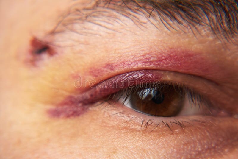 Close View of a Bruise Near the Eye, the Face of a Man with a Hematoma ...