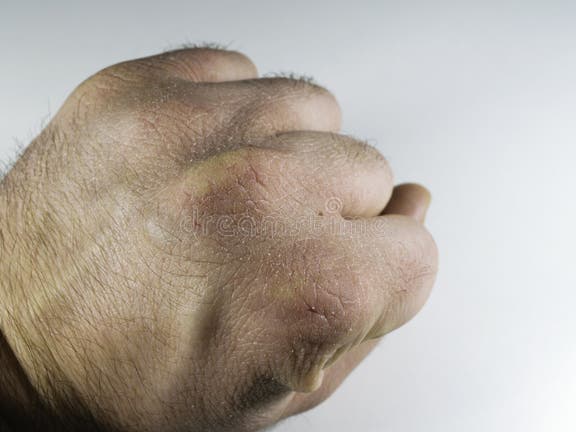 Close View of Dry and Cracked Hand Knuckles, Skin Problem Stock Photo ...