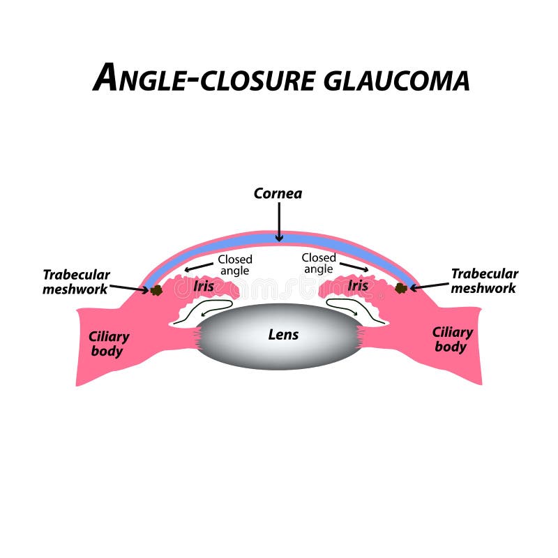 Closed Angle Glaucoma. a Common Type of Glaucoma. the Anatomical ... Closed Angle Glaucoma. a Common Type of Glaucoma. the Anatomical ...