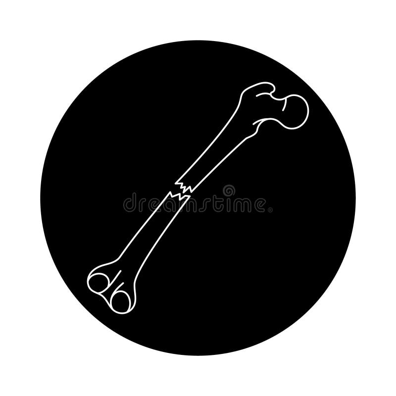 Closed Fracture Stock Illustrations – 291 Closed Fracture Stock ...