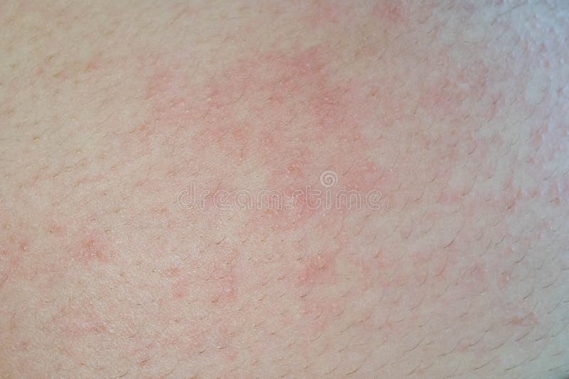 Irritated Skin during Pregnancy Stock Photo - Image of patient, disease ...