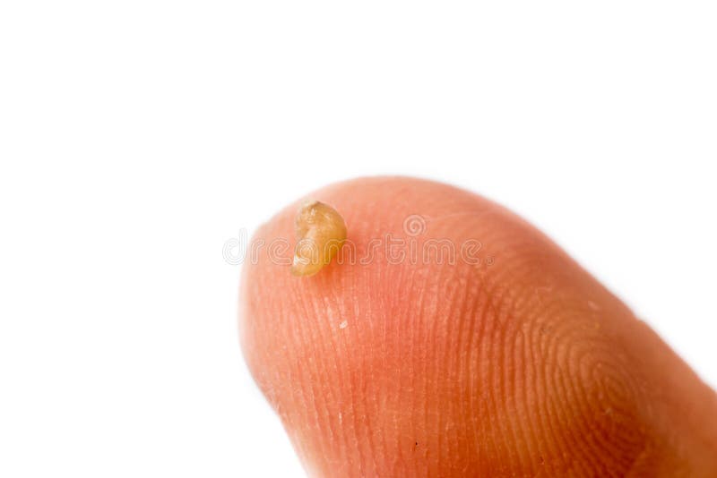 Closed-up of Acne, Pimples and Blackheads on Facial Skin Stock Image ...