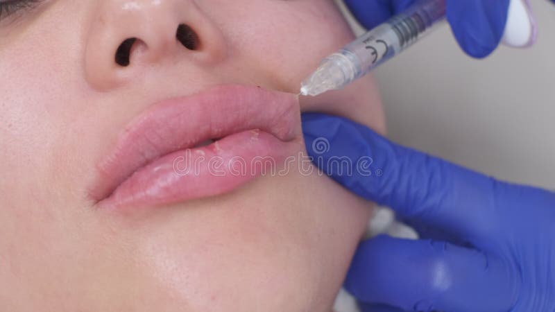 Closeup of Botox Lip Injection Using Syringe Stock Footage - Video of ...