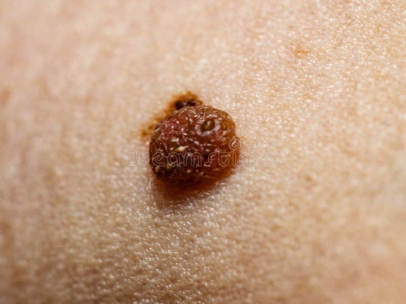 Closeup Brown Mole On Caucasian Woman Skin Stock Image Image Of