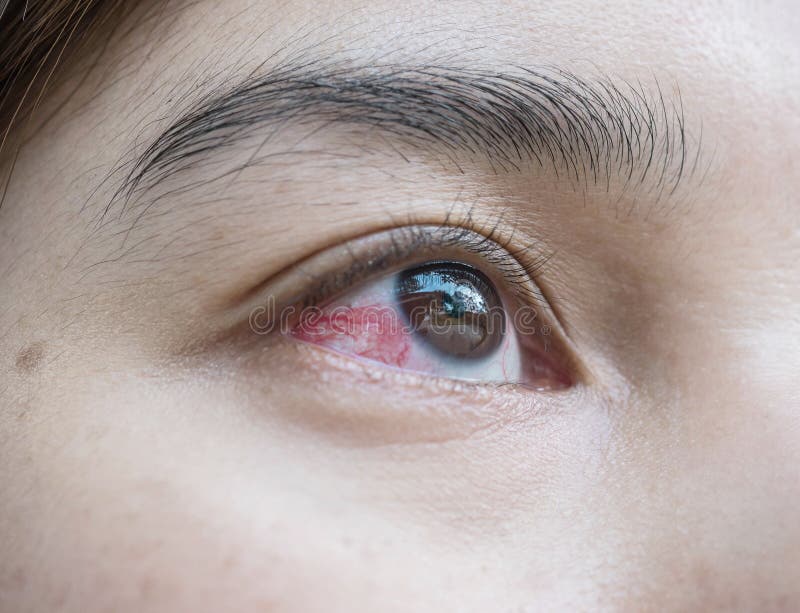 Closeup Eye of Asian Woman with Broken Capillaries in the Eye Stock ...
