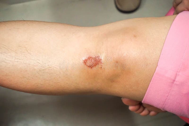 Closeup Human Knee Abrasions from Fall Accident Stock Image - Image of ...