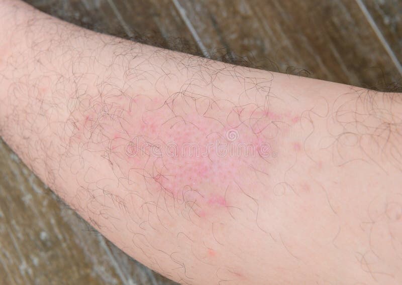 Closeup Human Legs with Scar Texture Stock Photo - Image of closeup ...