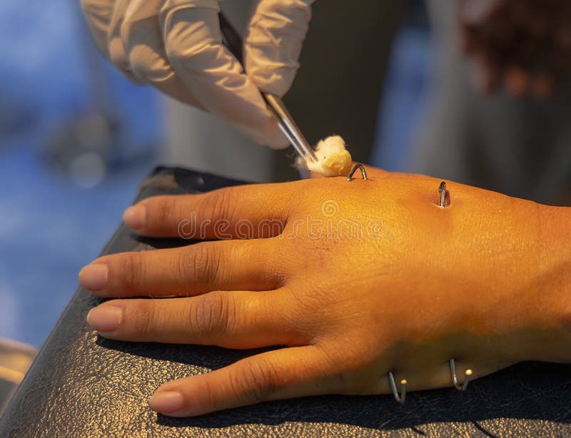 Internal Fixation of Hand Fractures Stock Image - Image of film ...