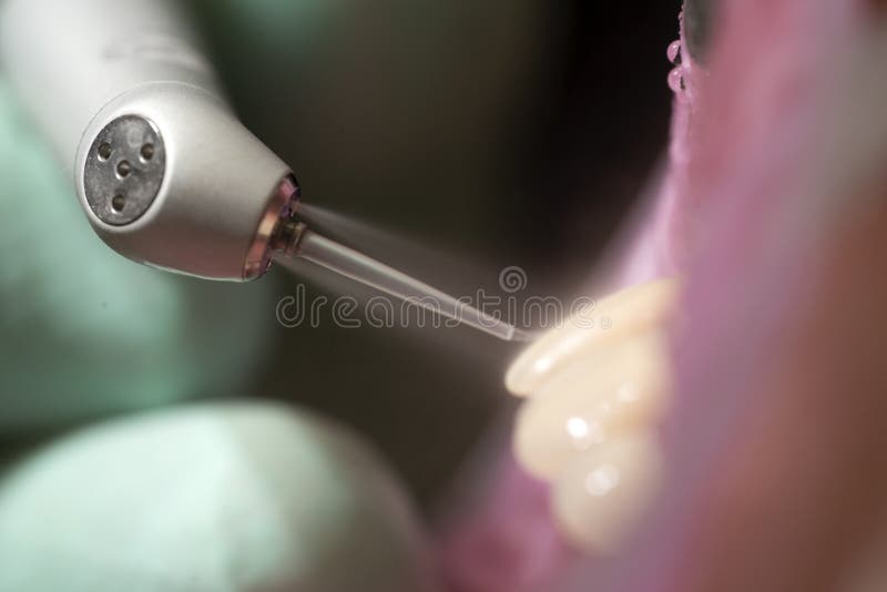 Closeup of Laser Etching Teeth Procedure Stock Image - Image of enamel ...