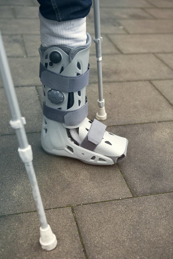 Closeup of Person Walking with Cast on Foot Stock Photo - Image of ...