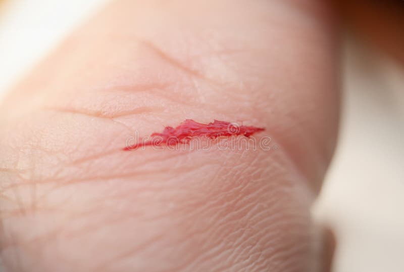 Closeup of Scratch with Blood on Man Hand Stock Image - Image of ...