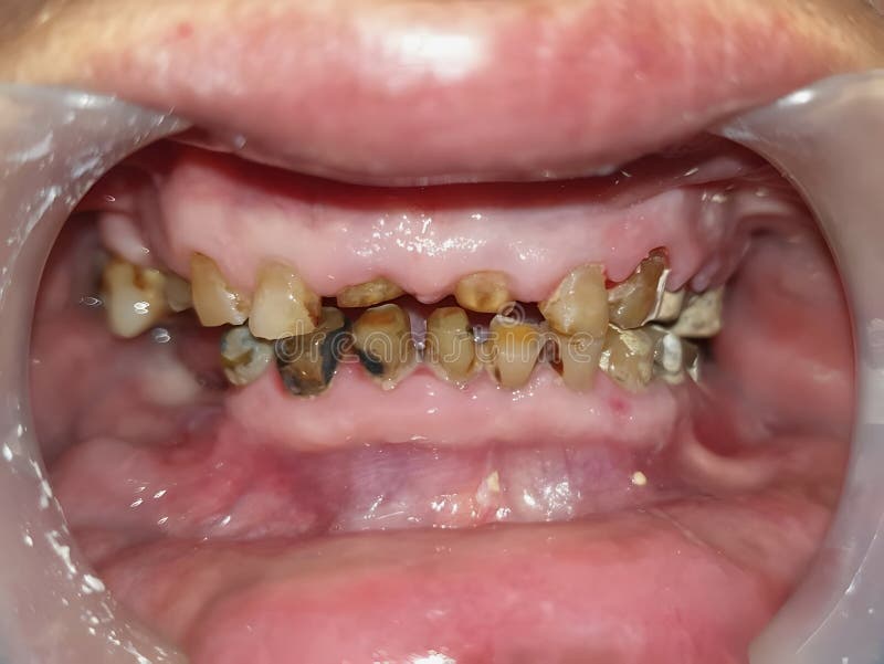 Closeup of Severely Damaged and Decayed Teeth Stock Image - Image of ...