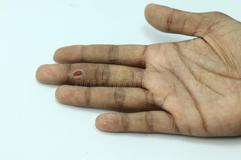 Wart Scar Stock Photos - Free & Royalty-Free Stock Photos from Dreamstime