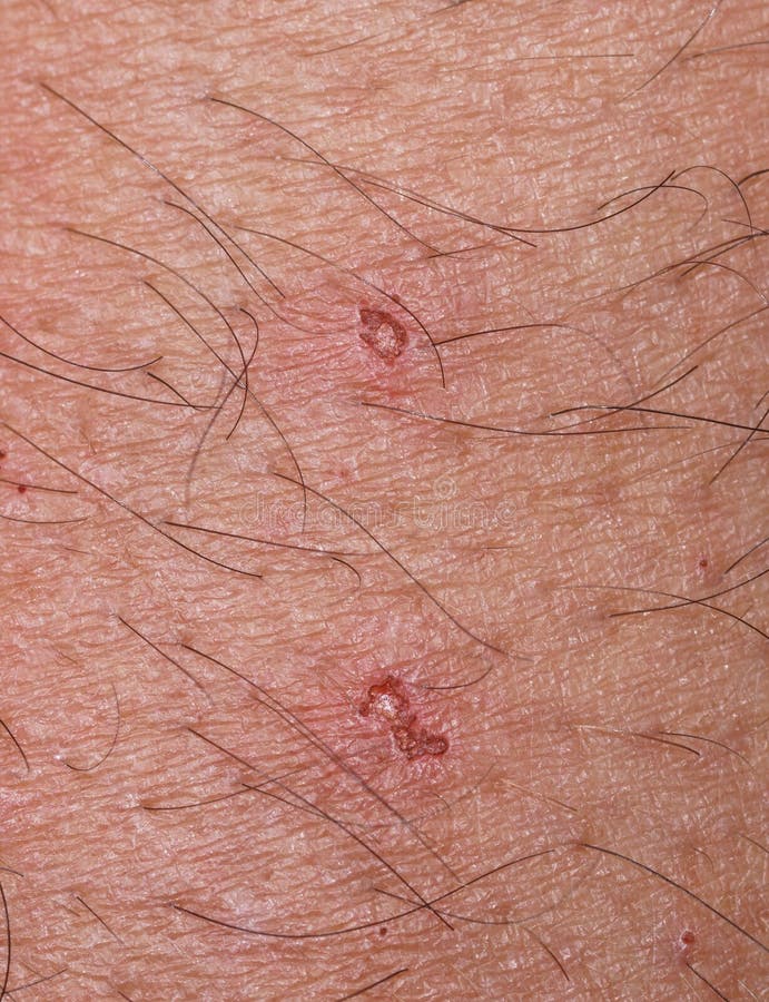 Closeup of Spot with Scab Over Caucasian Skin Stock Photo - Image of ...