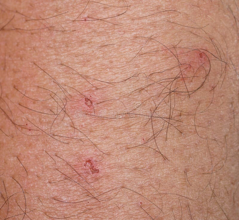 Closeup of Spot with Scab Over Caucasian Skin Stock Image - Image of ...