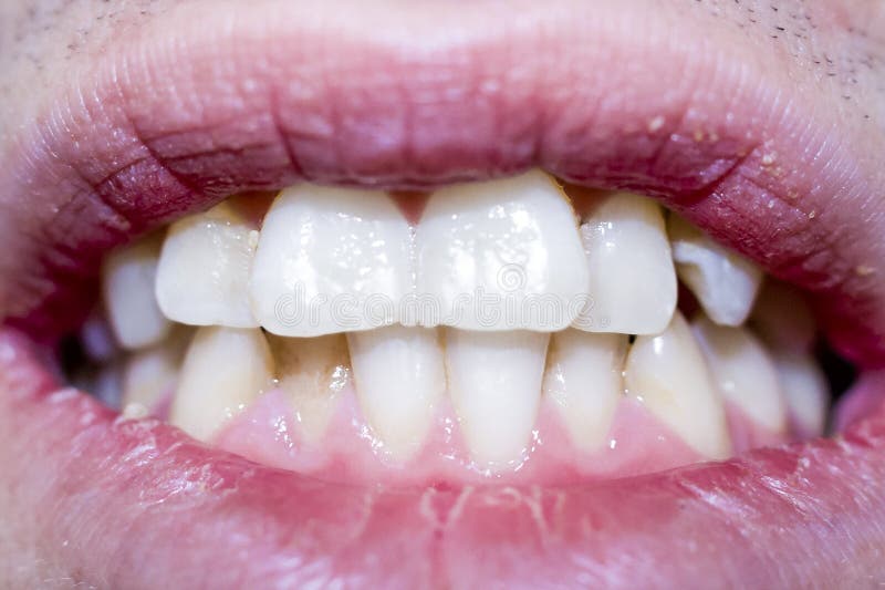Closeup of Teeth stock photo. Image of closeup, human - 35986488