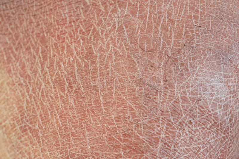Closeup View of Dry Human Skin . Stock Photo - Image of medicine, care ...