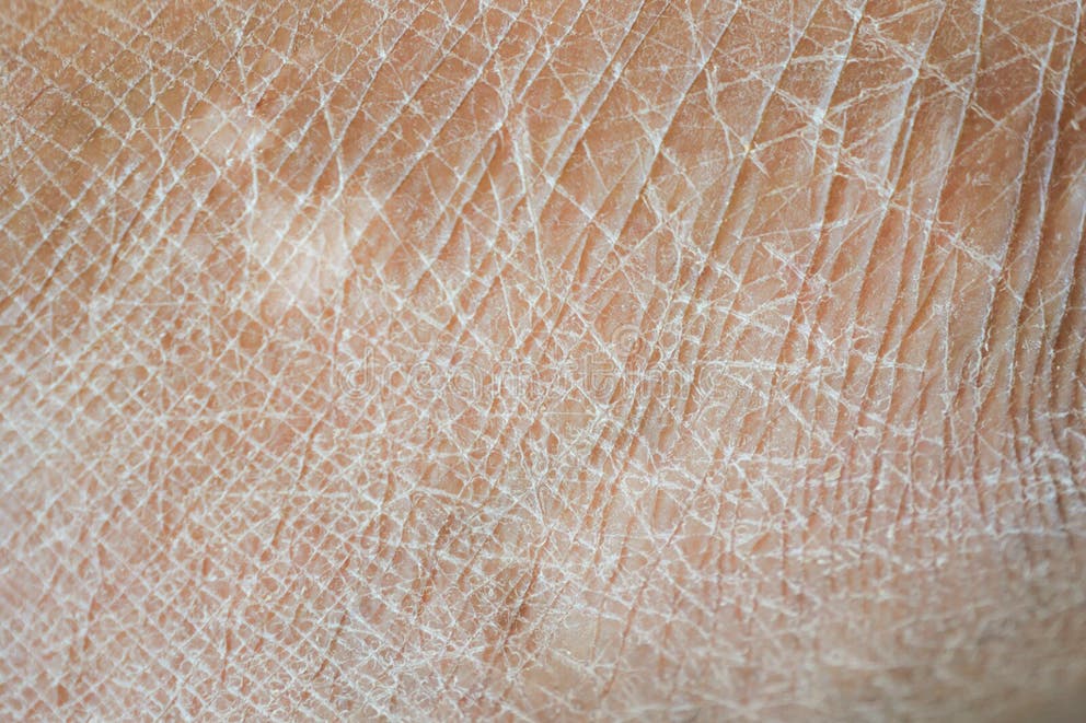 Closeup View of Dry Human Skin . Stock Photo - Image of moisturize ...