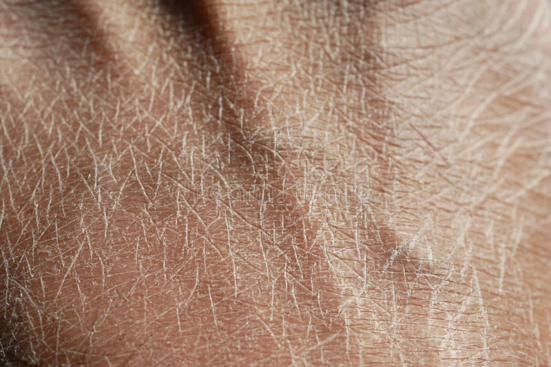 Closeup View of Dry Human Skin . Stock Photo - Image of medicine ...