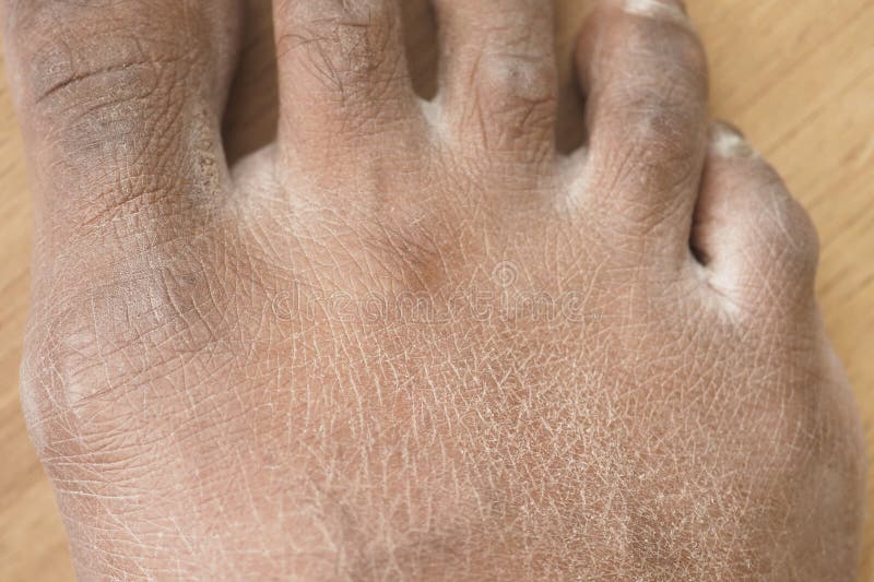 Closeup View of Dry Human Skin . Stock Photo - Image of moisturize ...