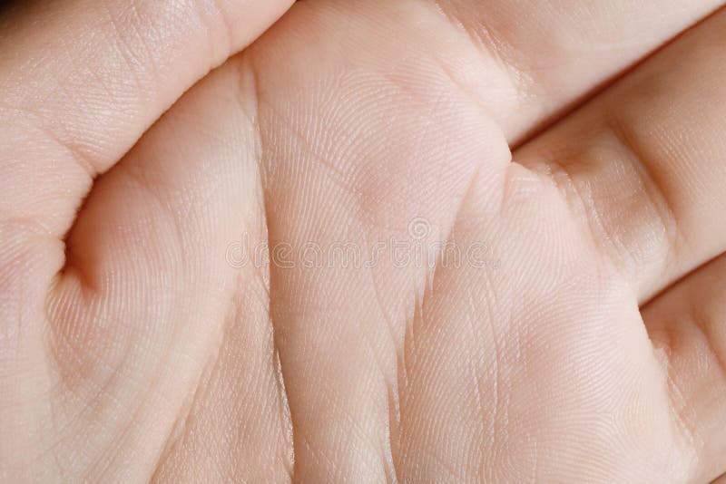 Closeup View of Human Hand with Dry Skin Stock Photo - Image of clean ...