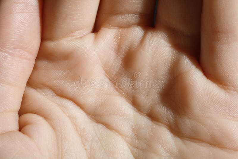 Closeup View of Human Hand with Dry Skin Stock Photo - Image of healthy ...