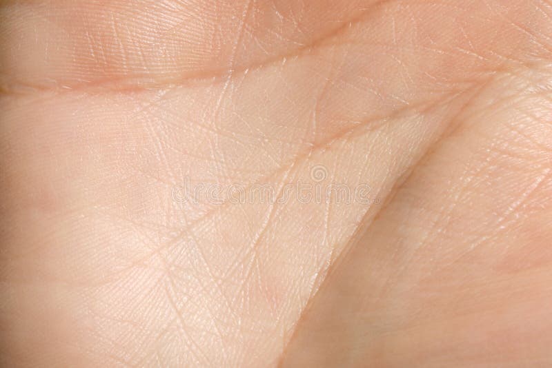 Closeup View of Human Hand with Dry Skin Stock Photo - Image of hygiene ...