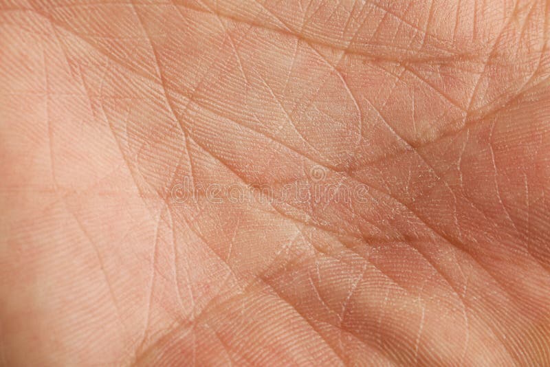 Closeup View of Human Palm with Dry Skin Stock Photo - Image of ...