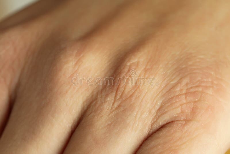 Closeup View of Person with Dry Skin on Hand Stock Image - Image of ...