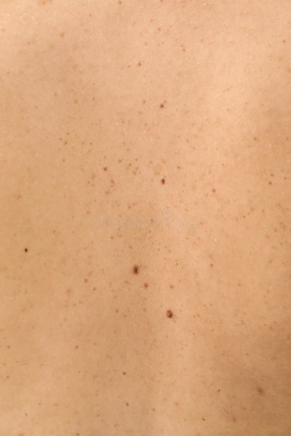 Closeup of Woman`s Body with Birthmarks As Background Stock Photo ...