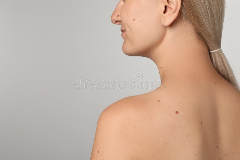 Closeup of Woman`s Body with Birthmarks on Light Grey Background, Back ...