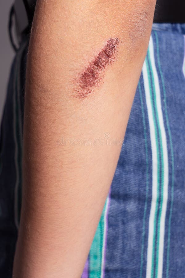 Elbow Wound Bandaging Arm By Nurse - First Aid Wrist Injury Health Care ...