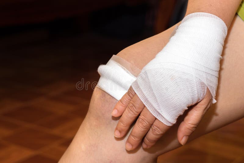 Cloth Wound Closure on Blood Blisters Reflection and Side Effect from ...