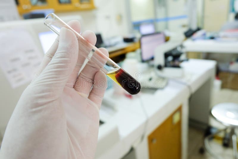 Clotted Blood with Serum in Tes Tube Stock Image - Image of chemistry ...