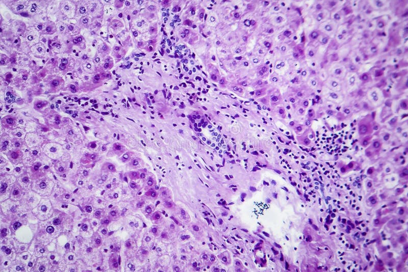 Cloudy Swelling of the Liver, Light Micrograph Stock Photo - Image of ...